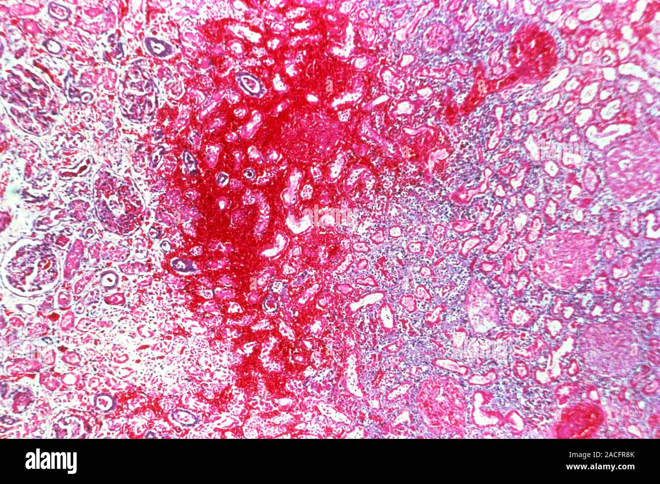 Kidney tissue death. Light micrograph of a section through kidney ...