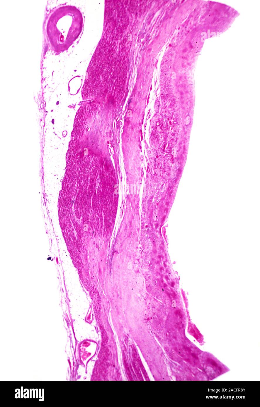 Heart attack scar. Light micrograph of a section through heart tissue ...