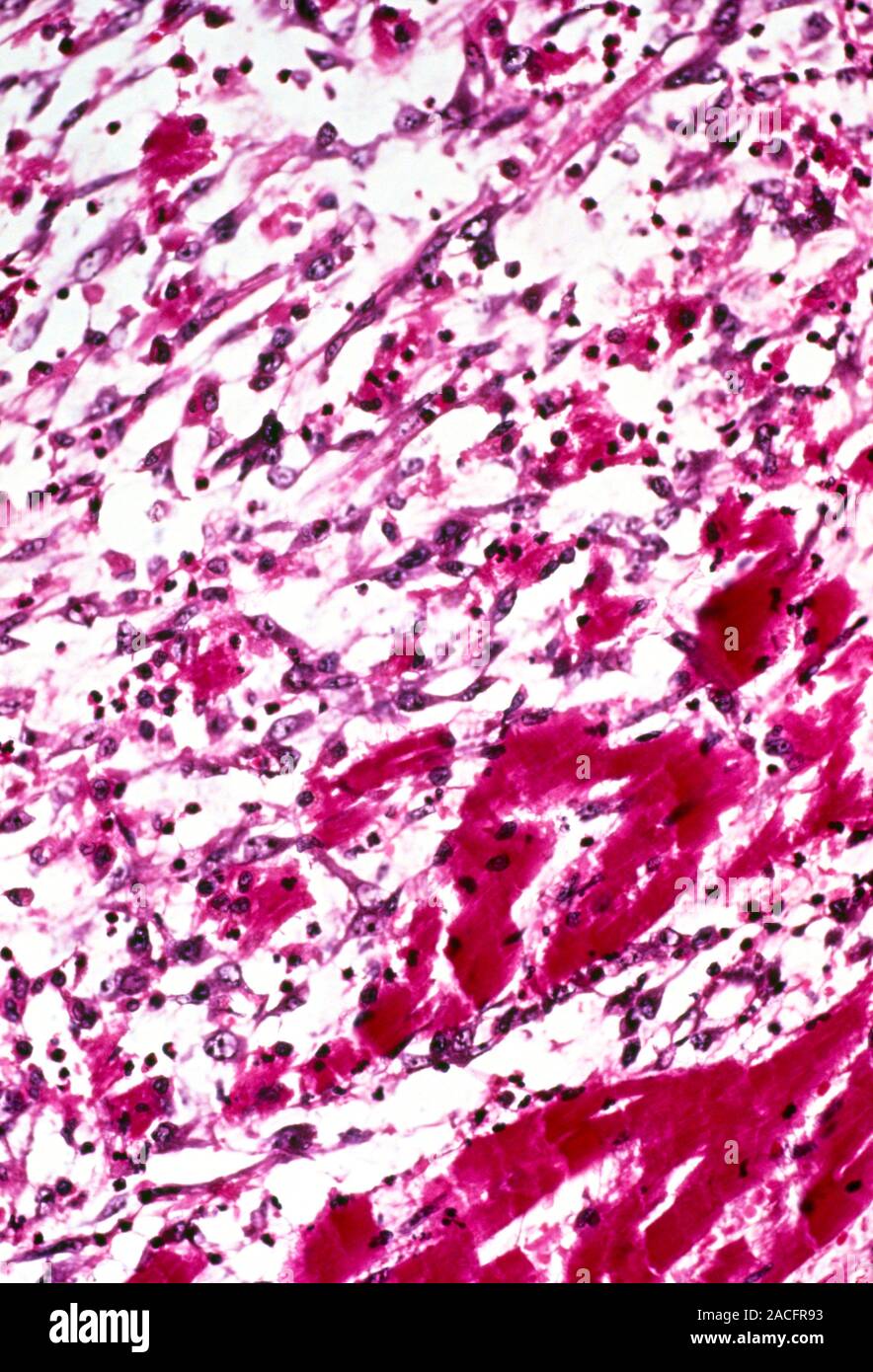 Heart scarring. Light micrograph of a section through heart tissue ...