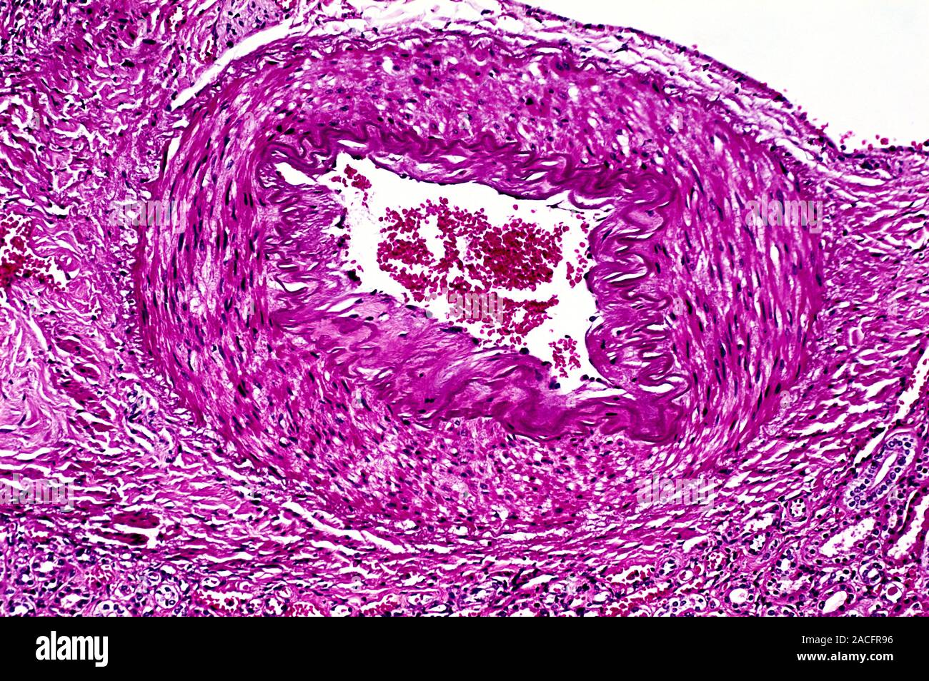 Kidney hypertension, light micrograph. Section through a kidney blood ...