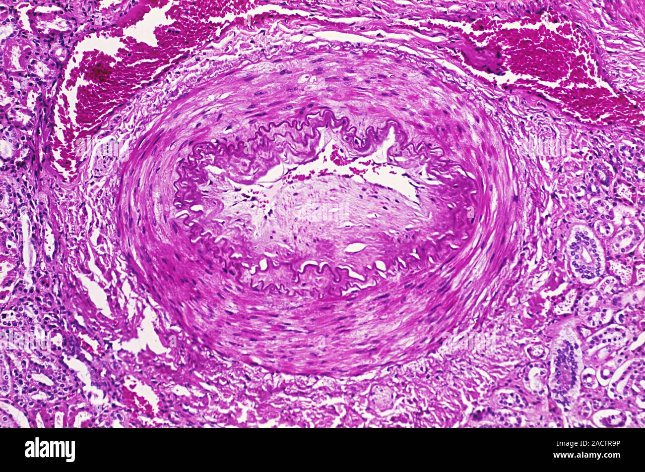 Kidney hypertension, light micrograph. Section through a kidney blood ...