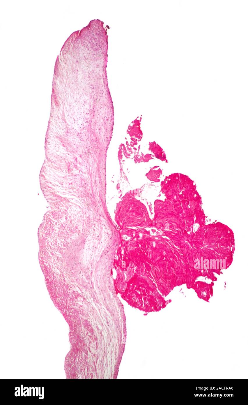 Heart growth, light micrograph. Section through a thrombotic vegetation ...