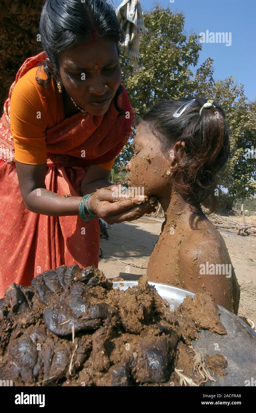 Cow dung treatment. Girl being treated by an application of cow dung ...