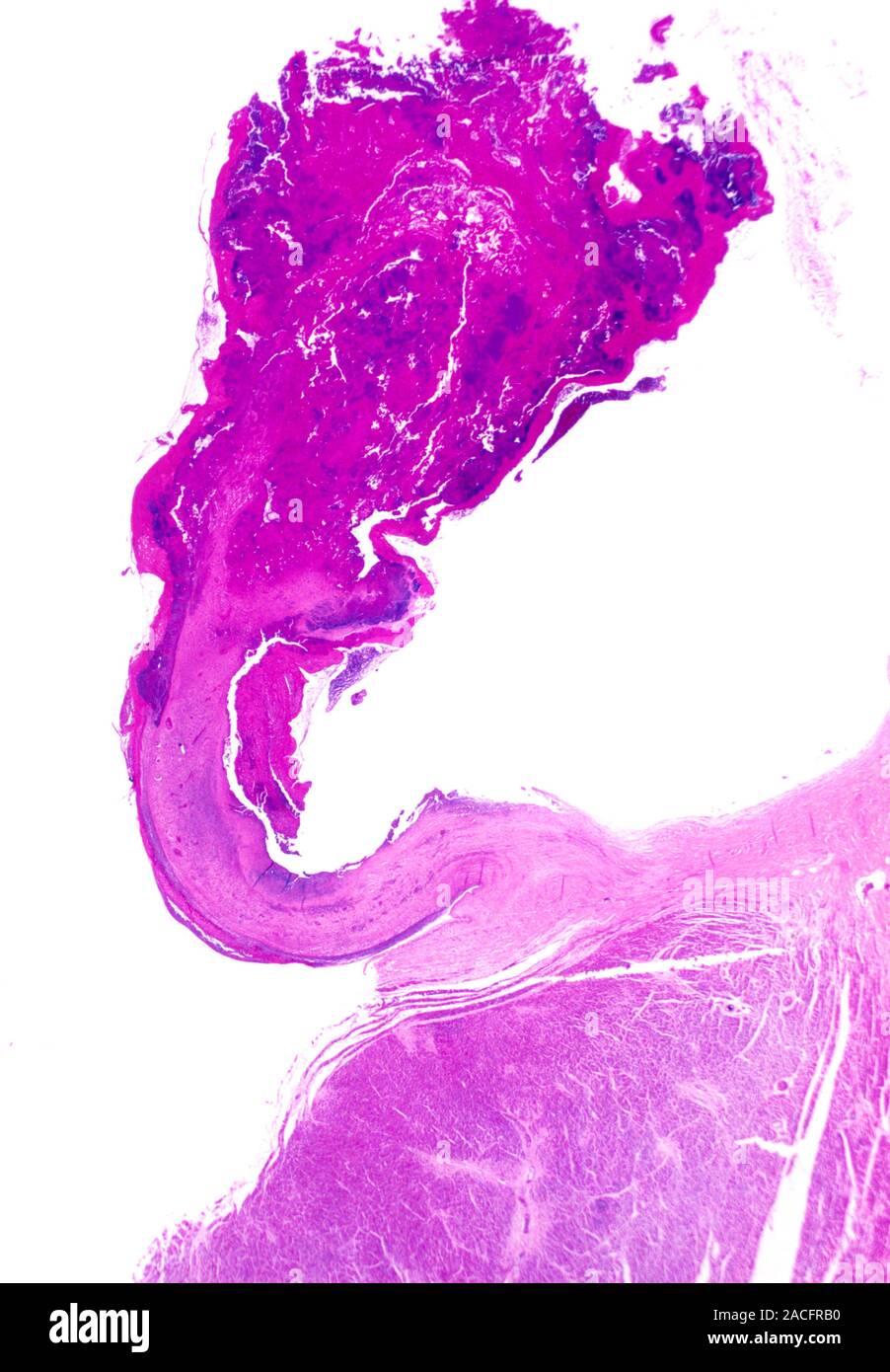 Heart growth, light micrograph. Section through a vegetation (lump ...