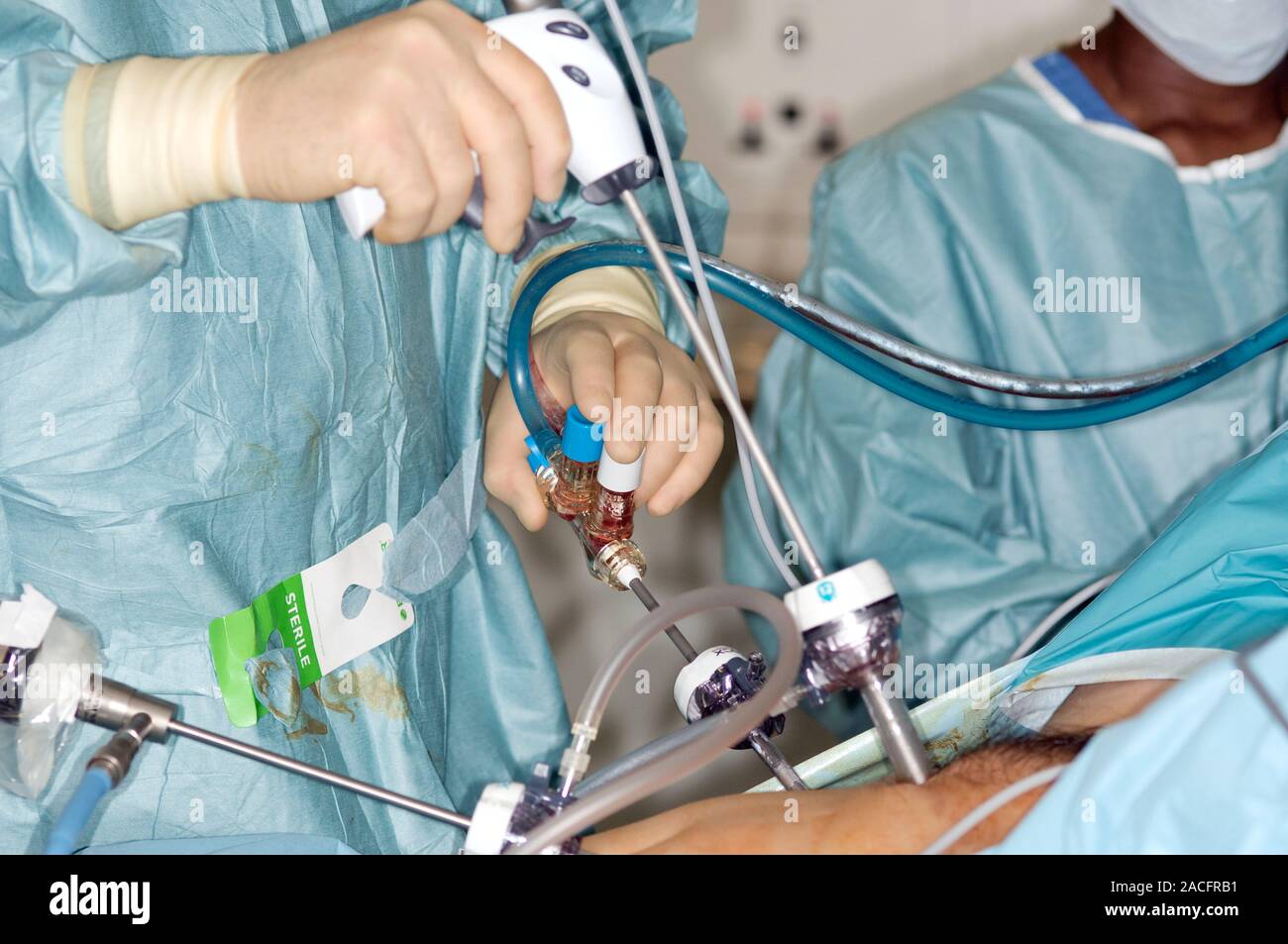 Key hole surgery (laparoscopy) instruments inserted in a woman's ...