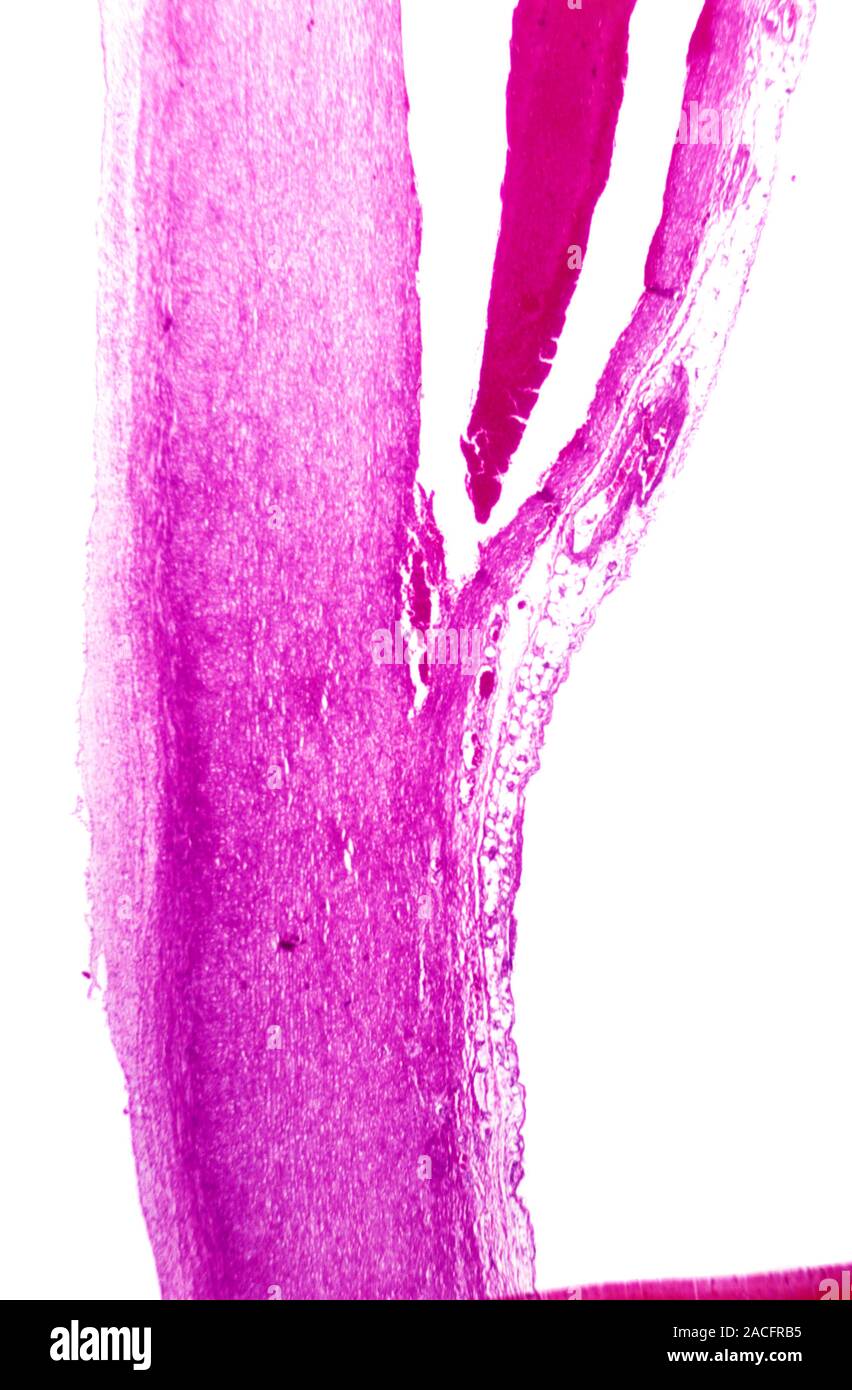 Dissecting aorta. Light micrograph showing a dissecting aorta, a type ...
