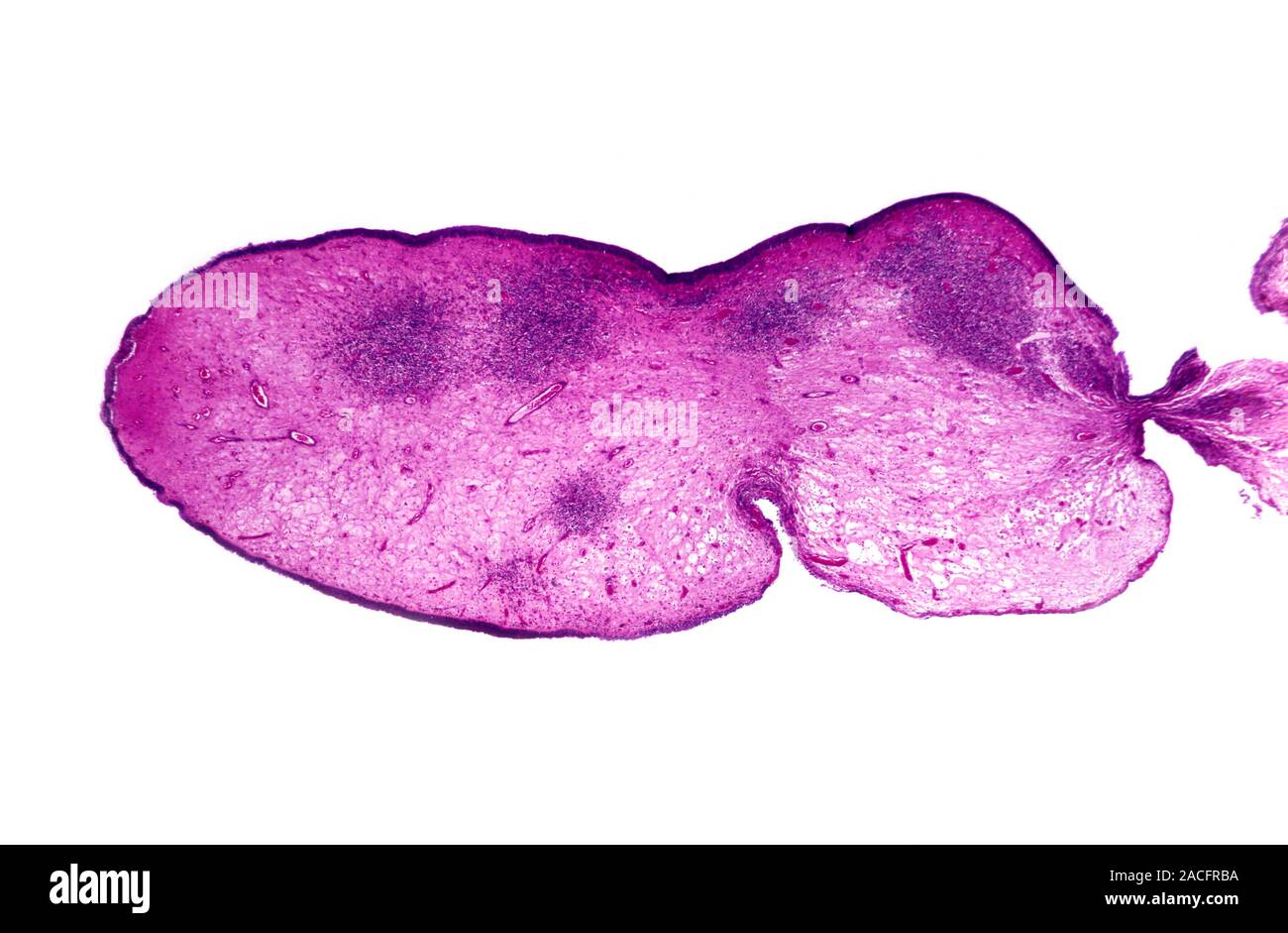 Nasal polyp, light micrograph. Polyps are tumours (growths) that occur ...