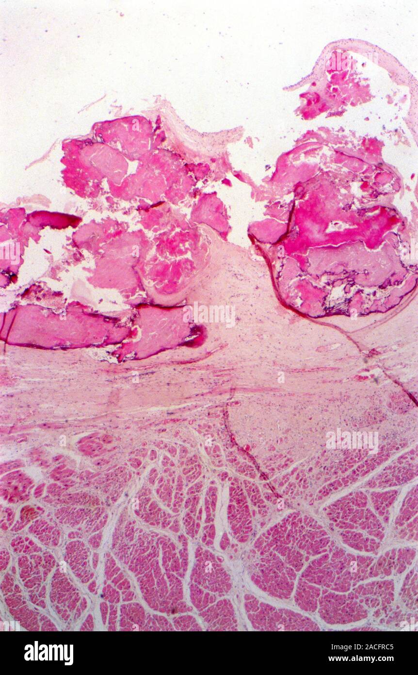 Heart growths, light micrograph. Section through heart tissue showing ...