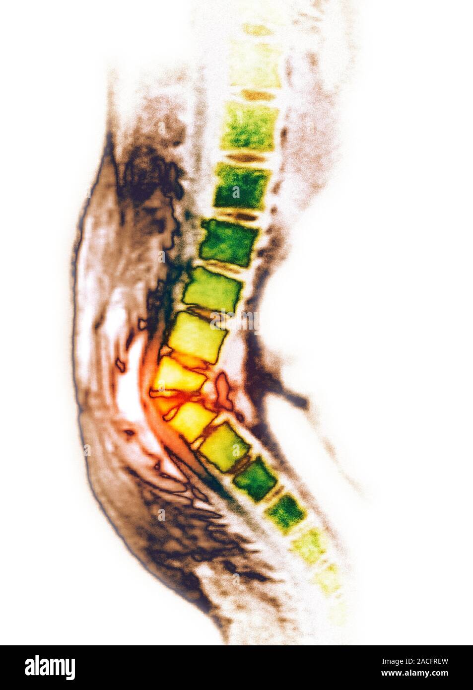 Coloured computed tomography (CT) scan of the spine of a patient ...