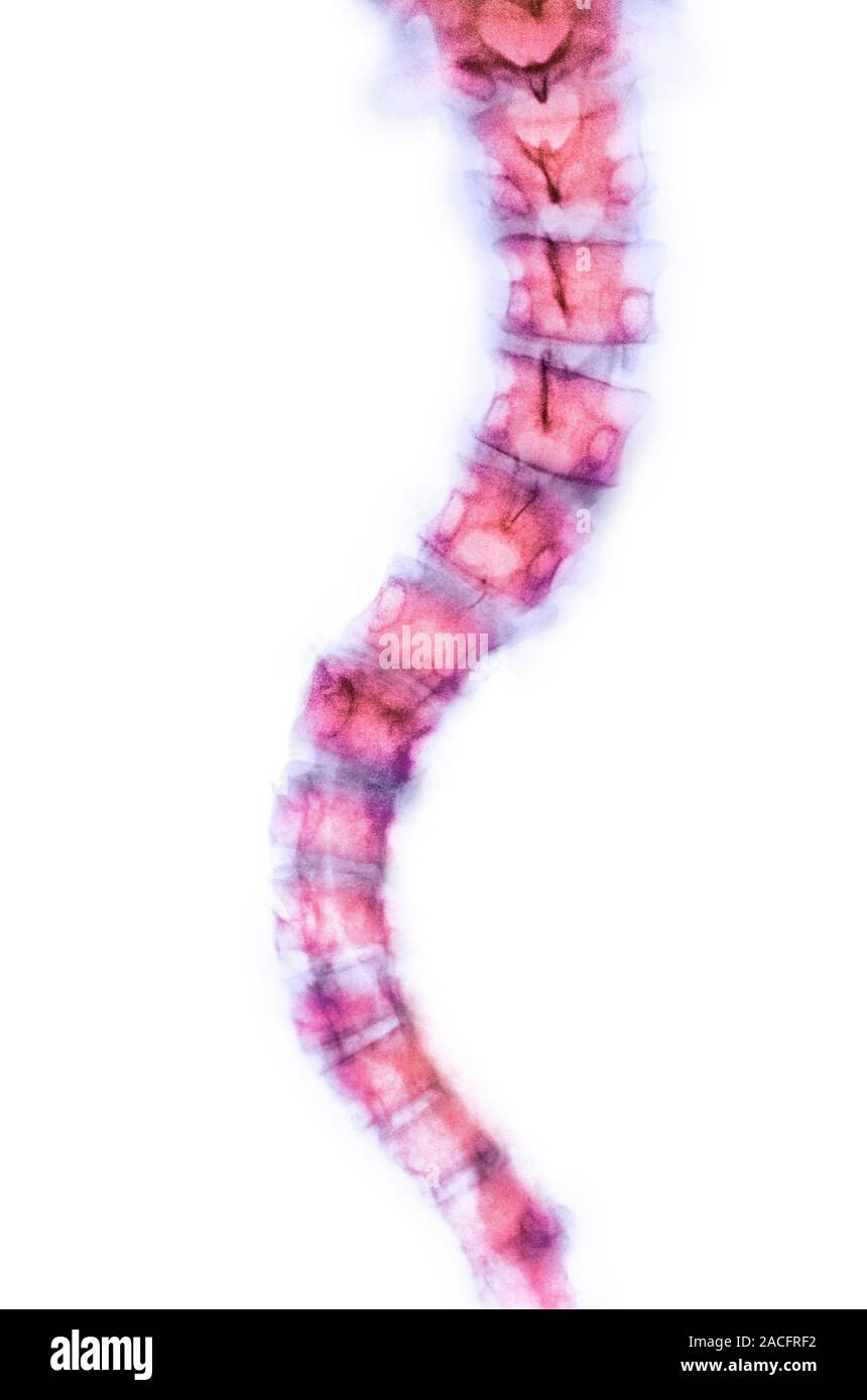 Coloured X-ray (back view) of the spine of an adolescent patient ...