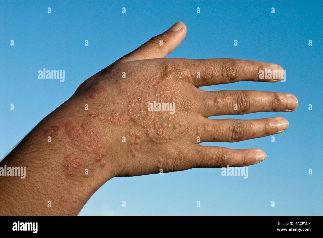 Allergic reaction to a henna tattoo on a man's hand. His immune system ...