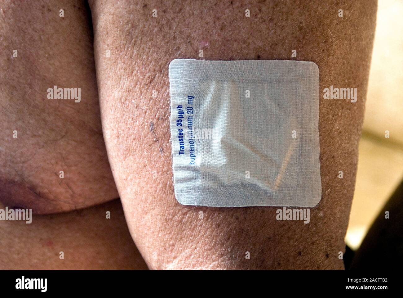 Painkiller patch. Transdermal patch on the arm of a 67-year-old man ...