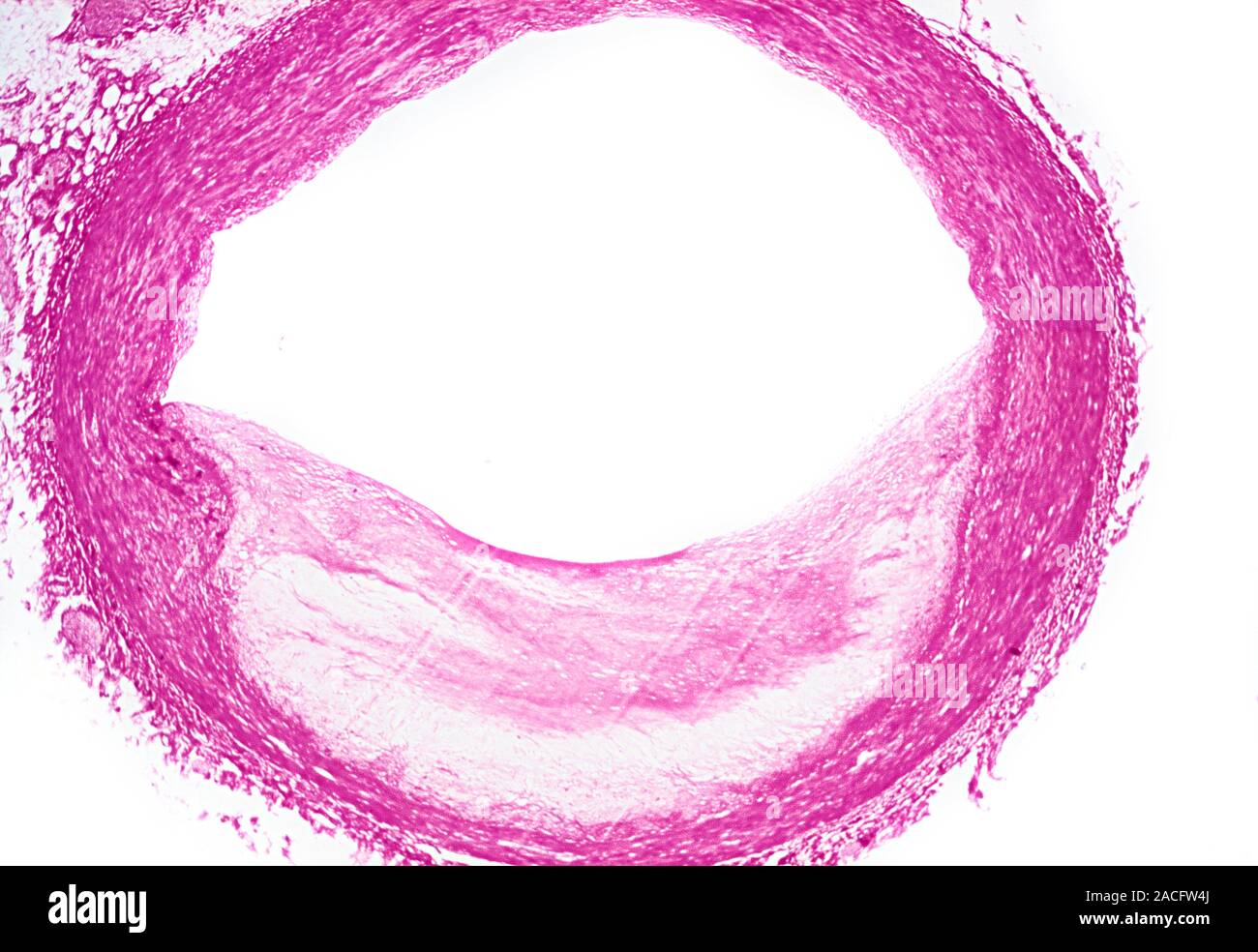 Narrowed artery. Light micrograph of a section through an artery that ...