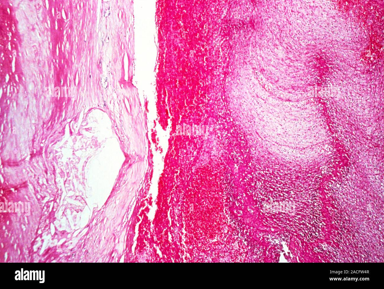 Complicated atheroma. Light micrograph of a section through an artery ...