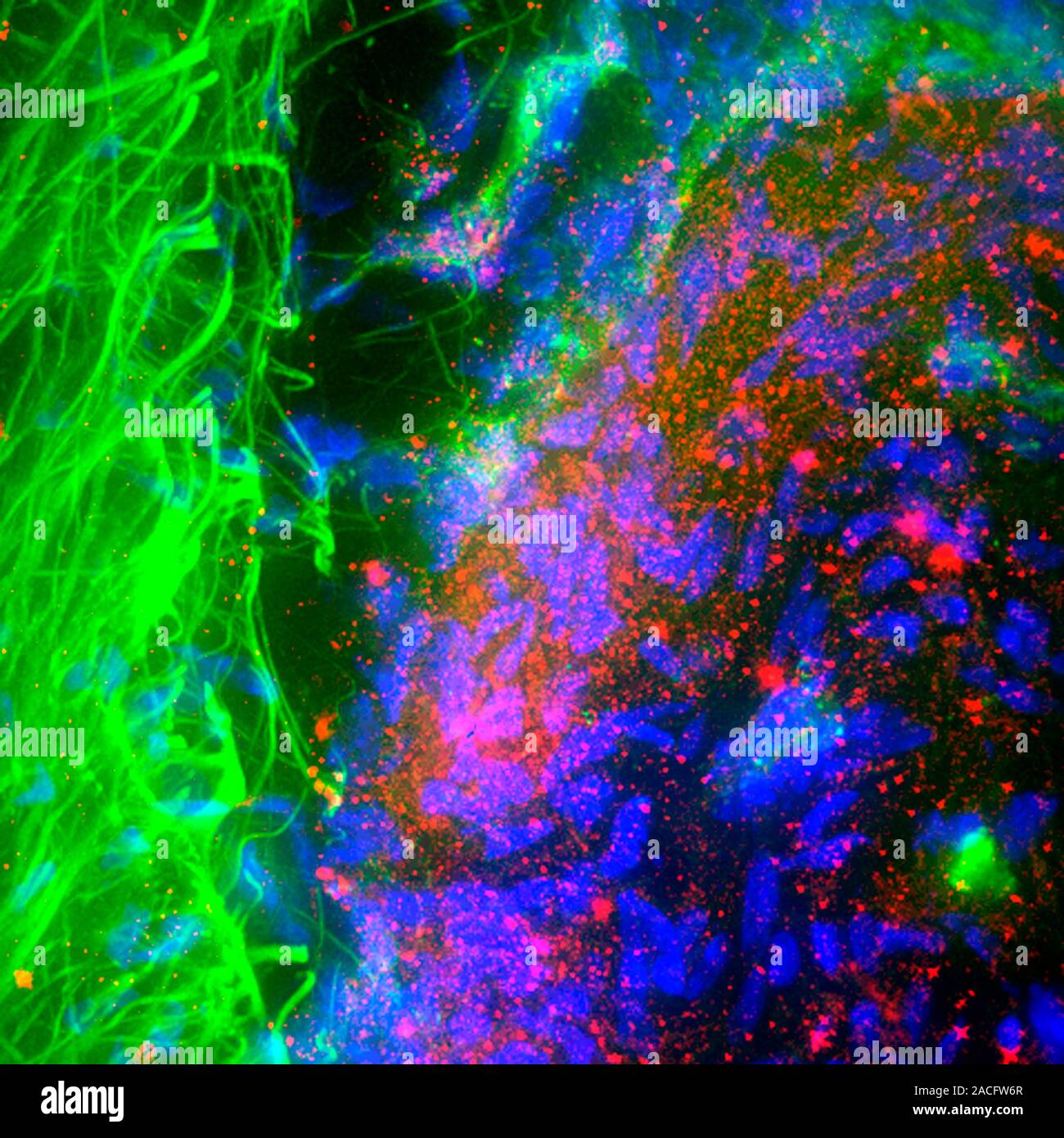 Parkinson's disease. Fluorescent deconvolution micrograph of a section ...
