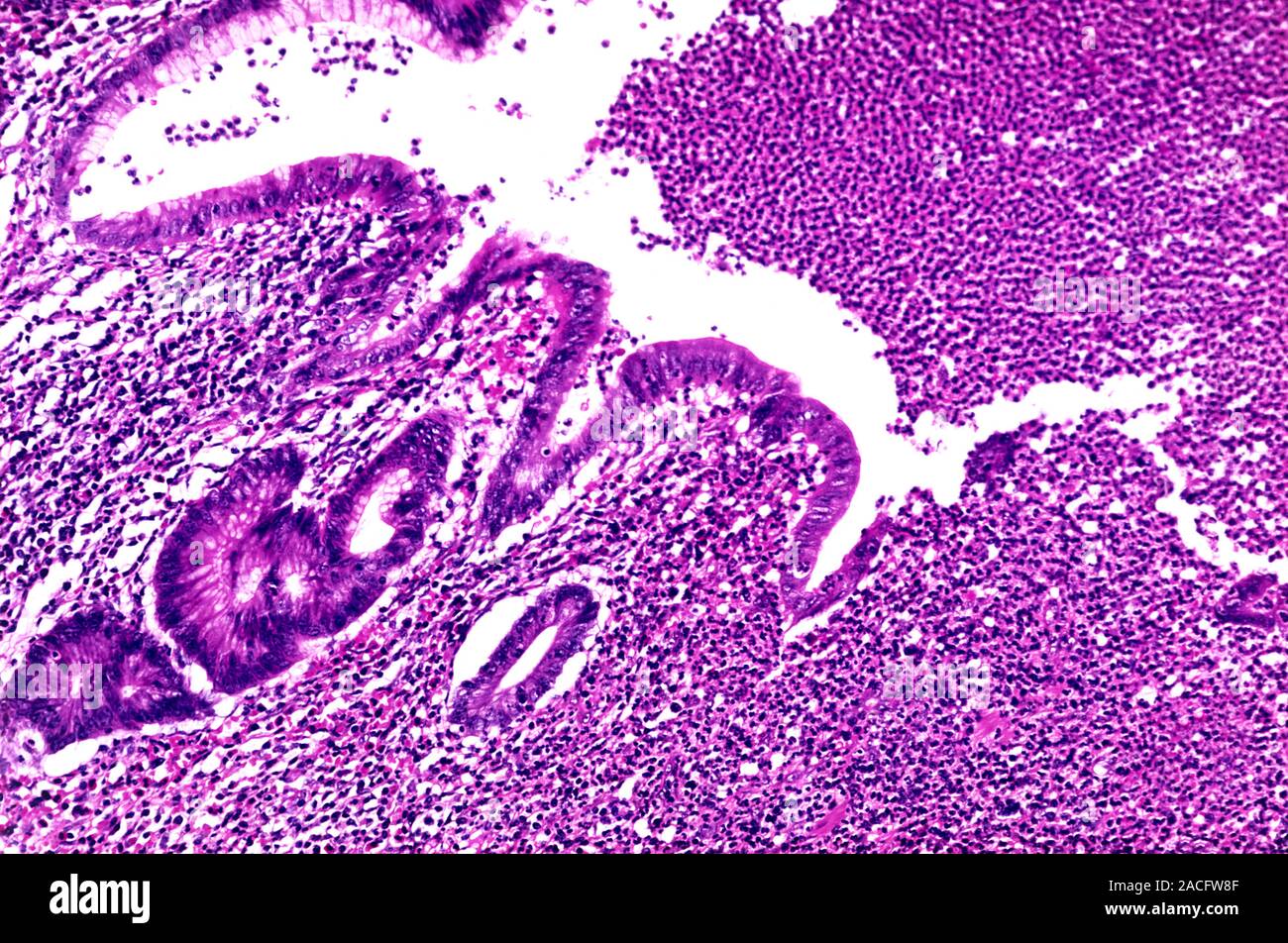 Acute appendicitis. Light micrograph through a section of an appendix ...