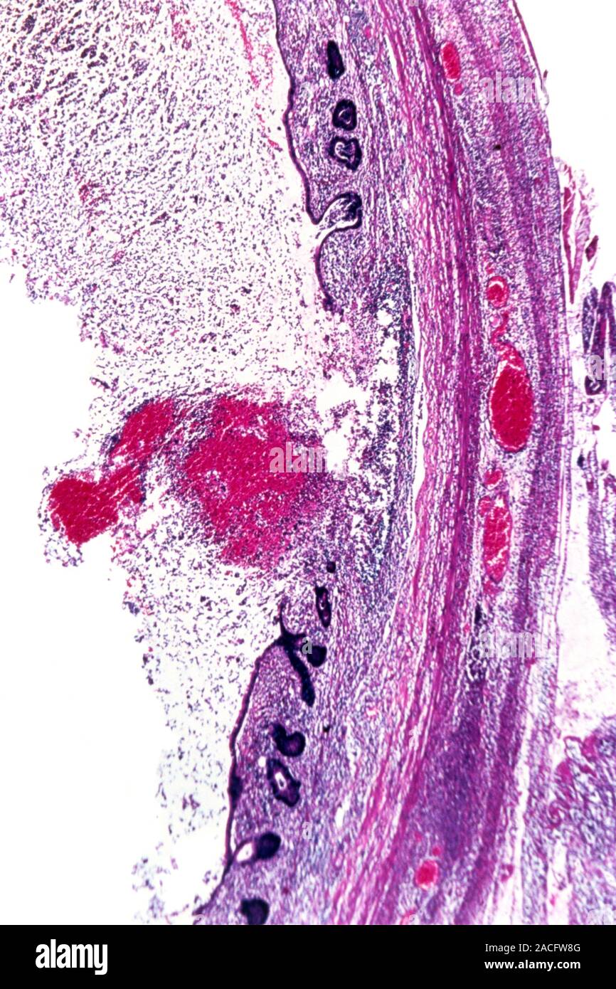 Acute Appendicitis Light Micrograph Through A Section Of An Appendix Showing Acute Appendicitis