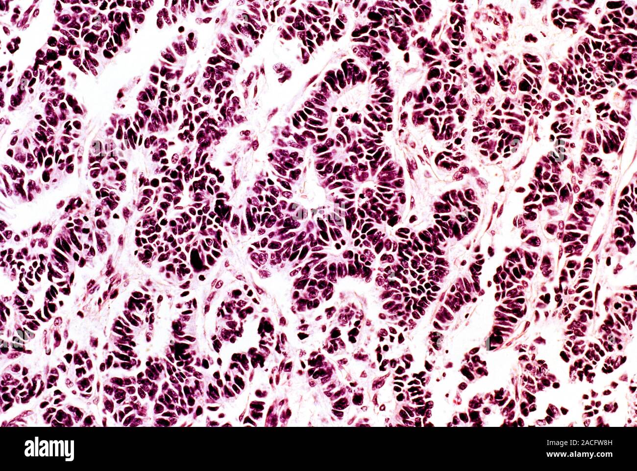Coeliac disease. Light micrograph of a section through the surface of a ...