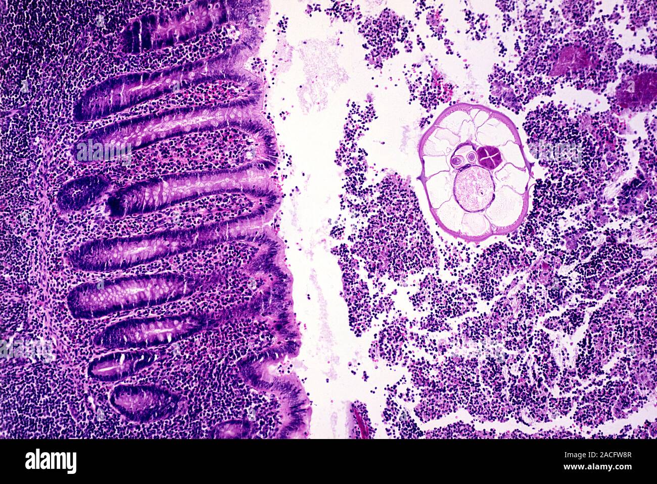 Acute Appendicitis Light Micrograph Through A Section Of An Appendix Showing Acute Appendicitis