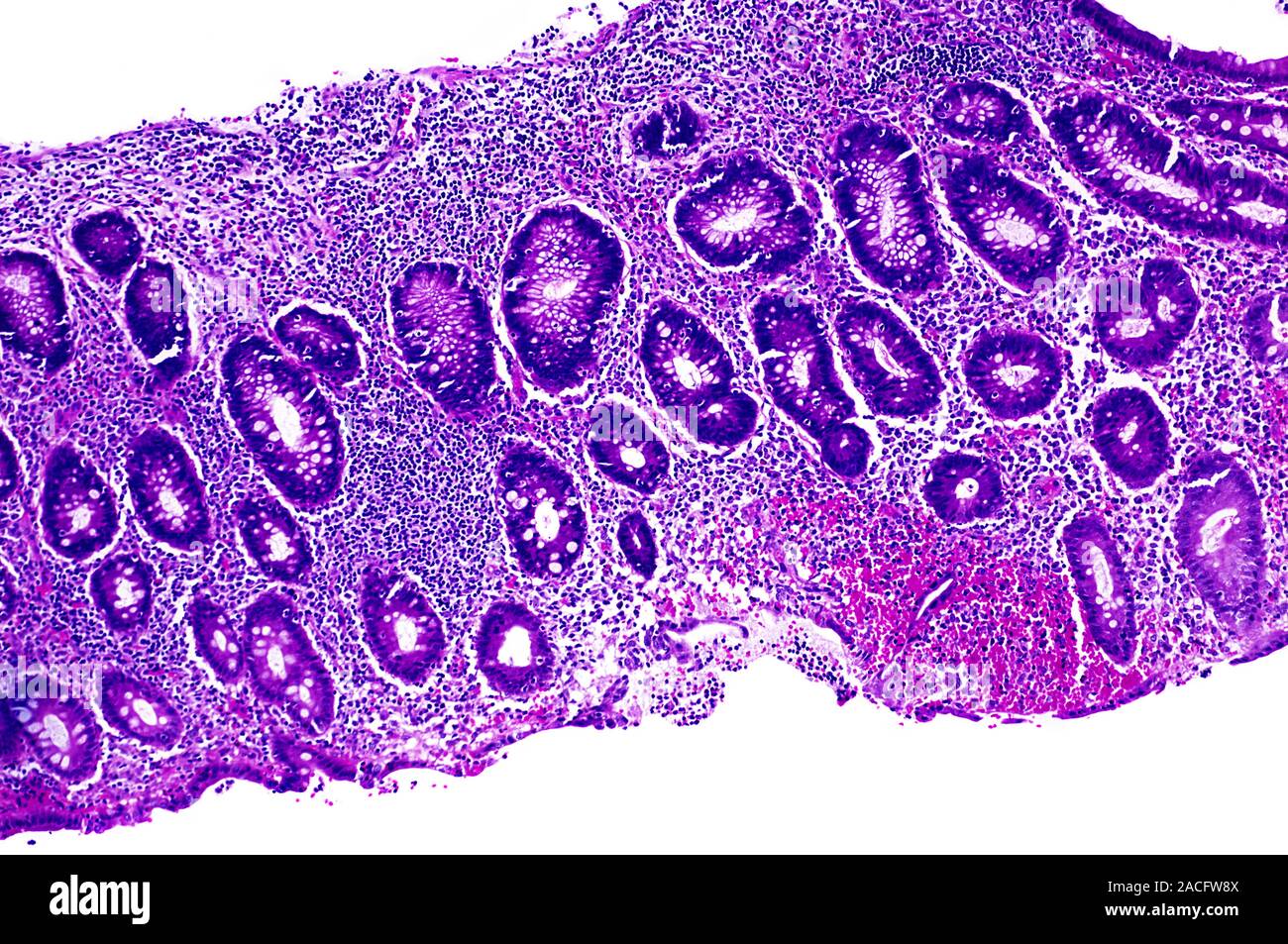 Ulcerative colitis. Light micrograph of a section through the colon ...