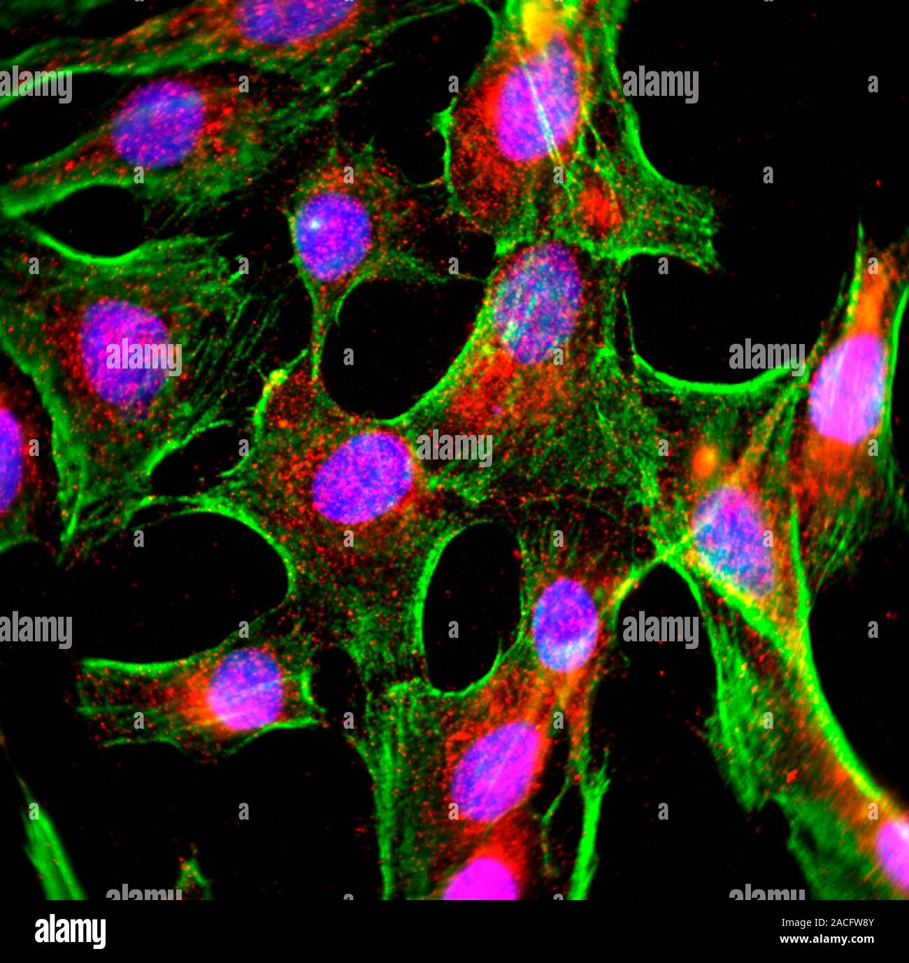 Parkinson's disease research. Fluorescent deconvolution micrograph of ...
