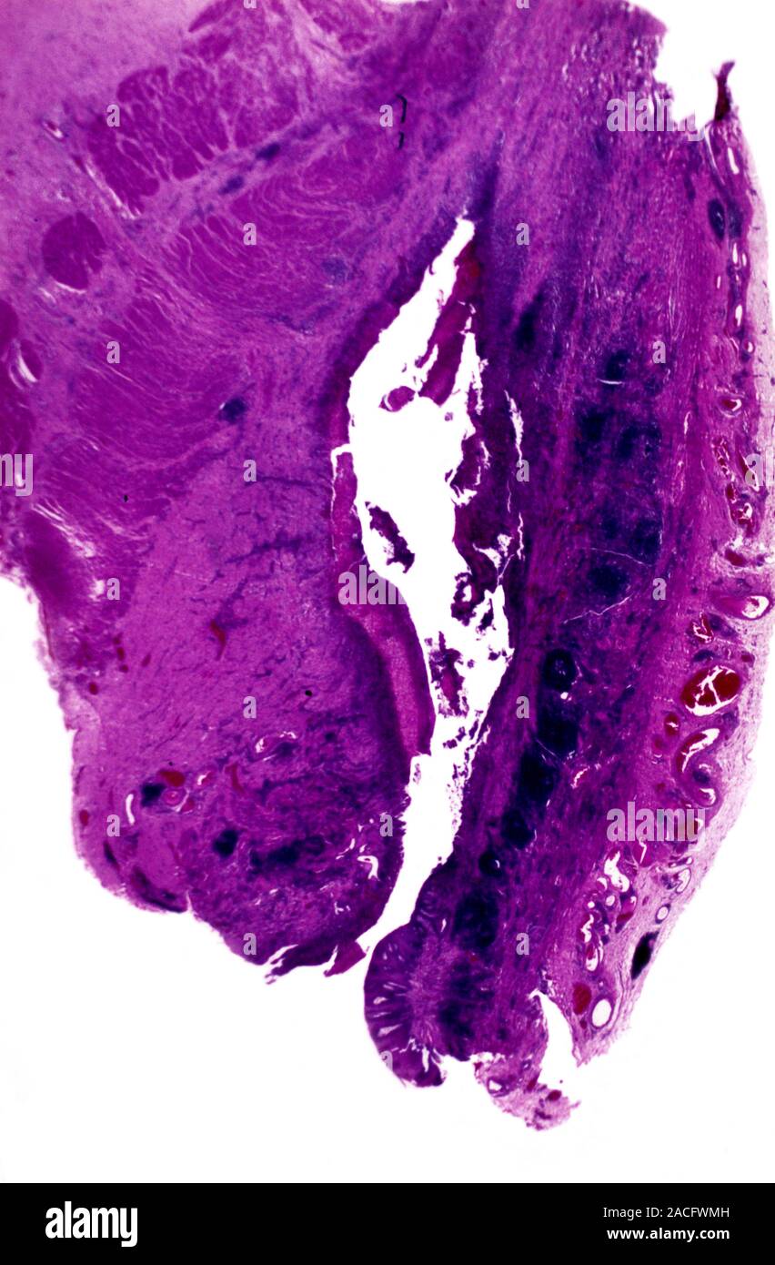Oesophageal ulcer. Light micrograph of a section through an oesophagus ...