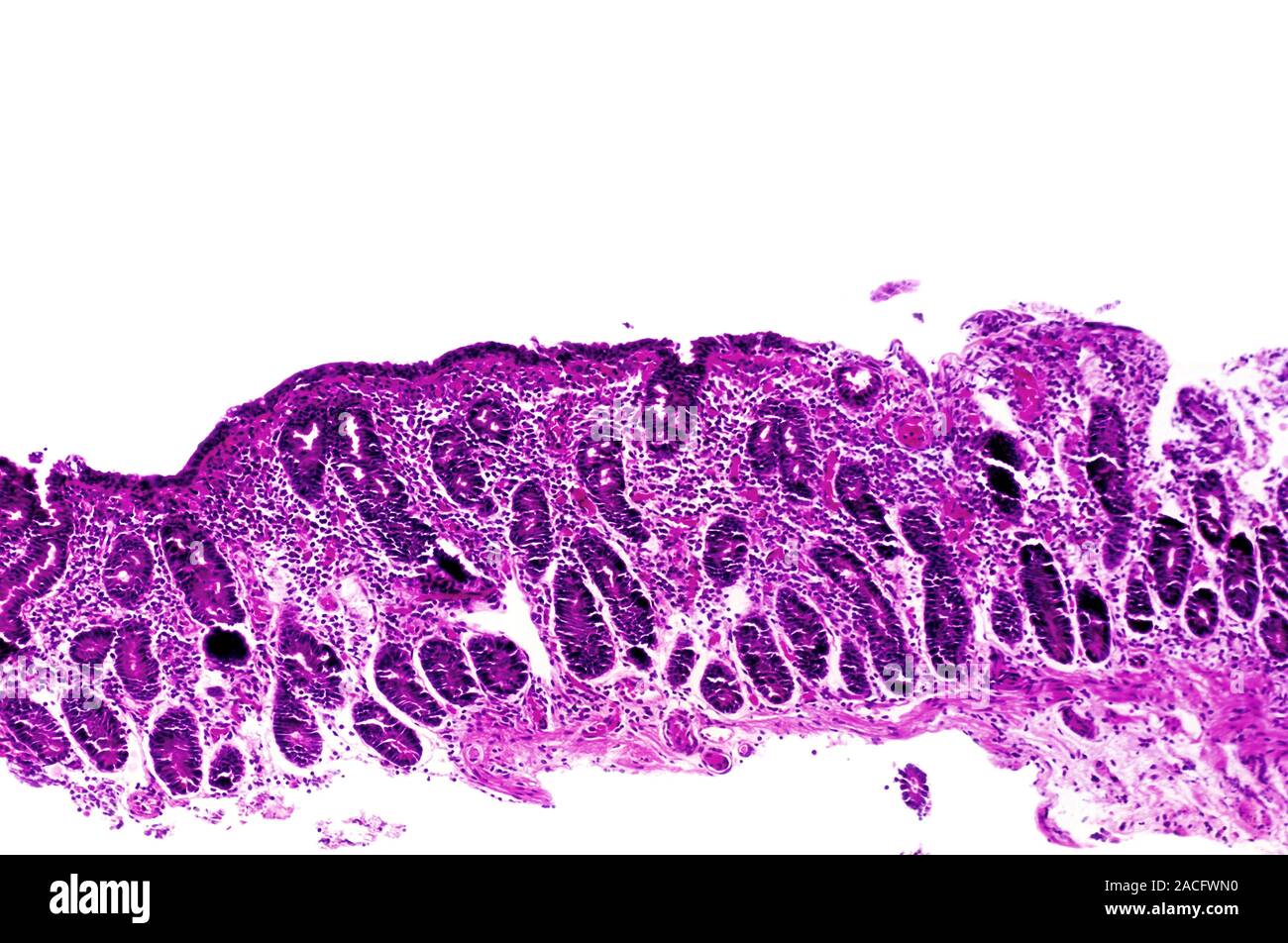 Coeliac disease. Light micrograph of a section through a jejunum ...