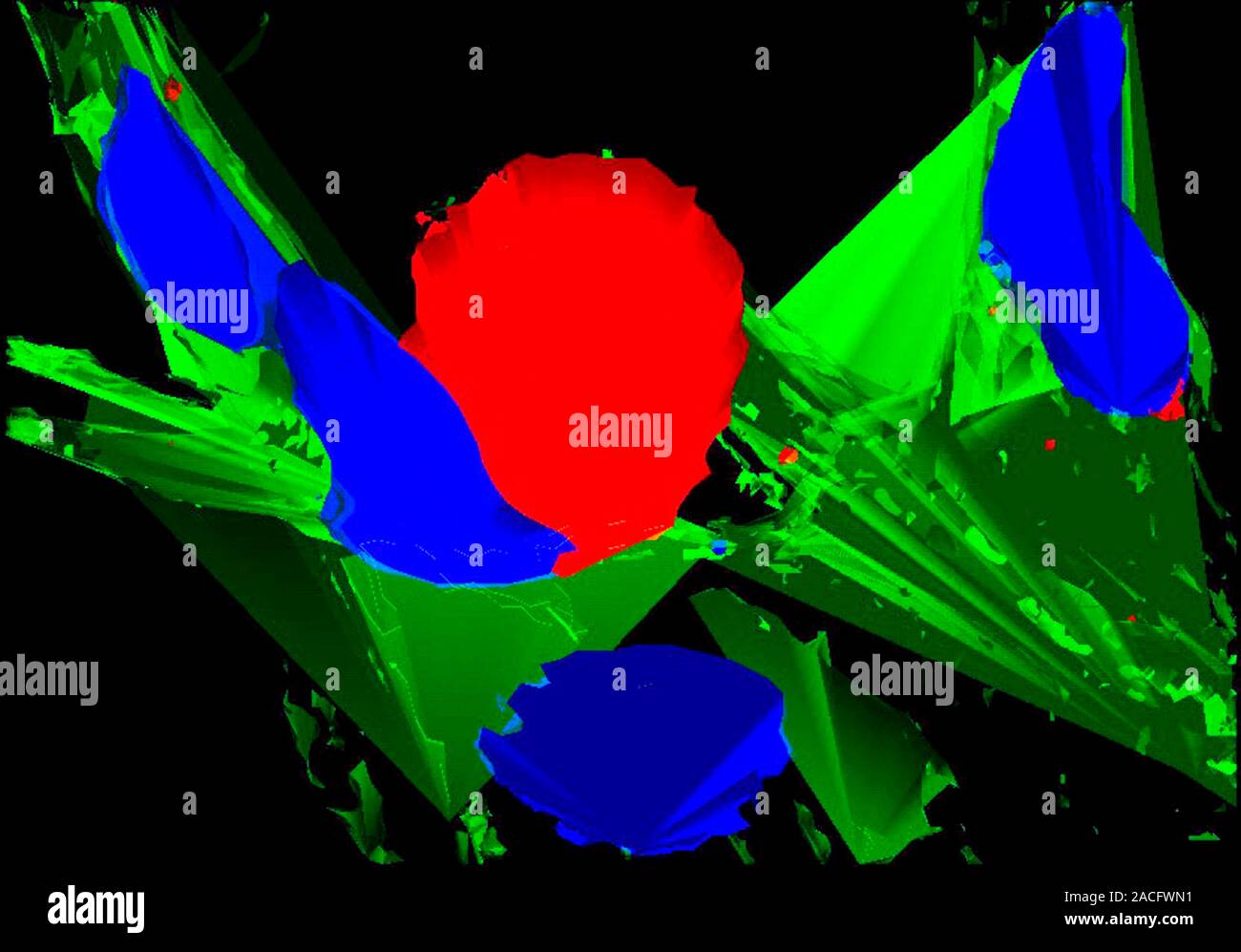 Parkinson's disease. Fluorescent deconvolution micrograph of brain ...
