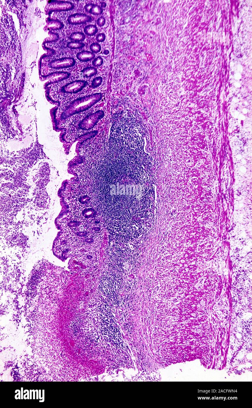 Acute appendicitis. Light micrograph through a section of an appendix ...