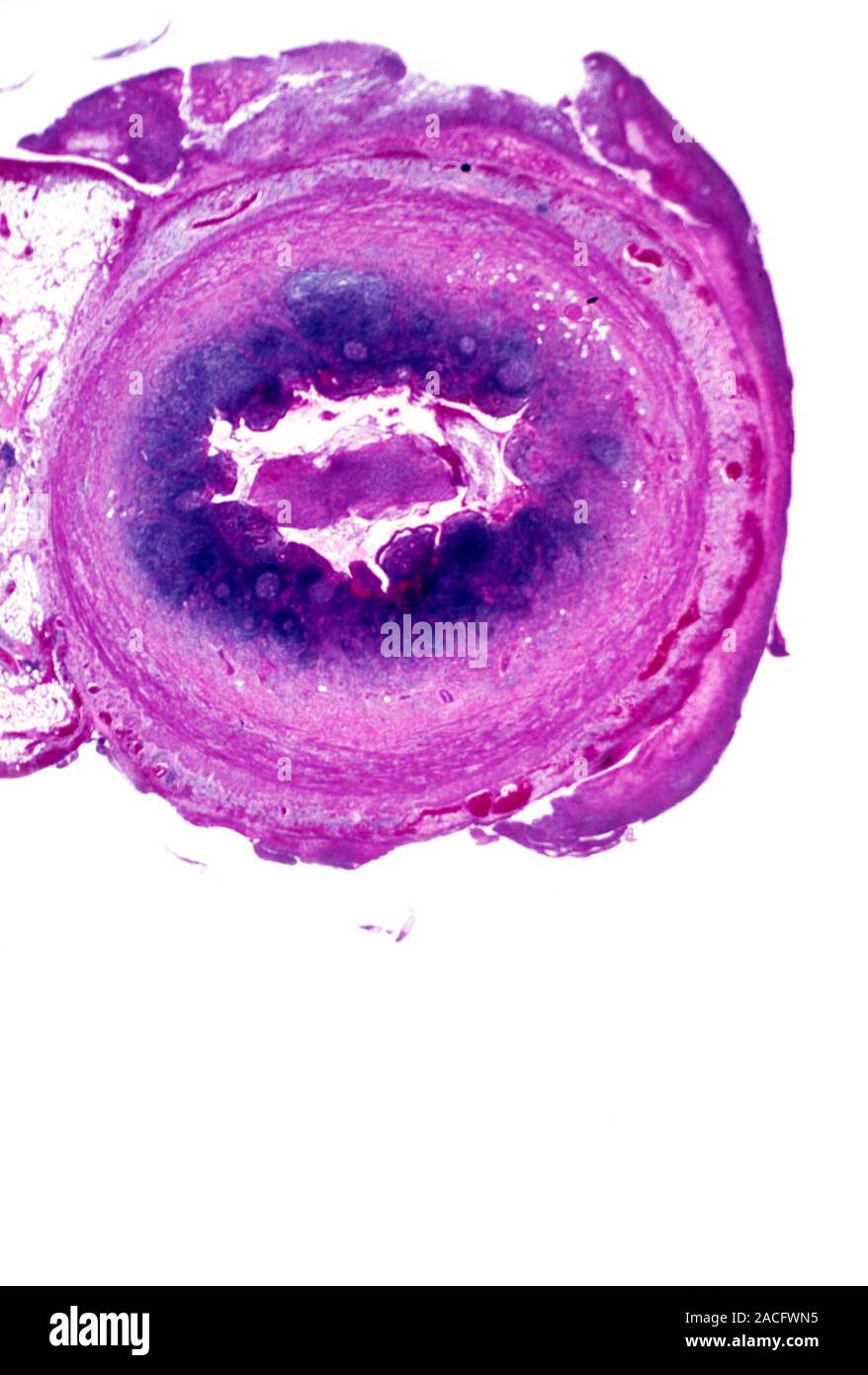 Acute appendicitis. Light micrograph through a section of an appendix ...