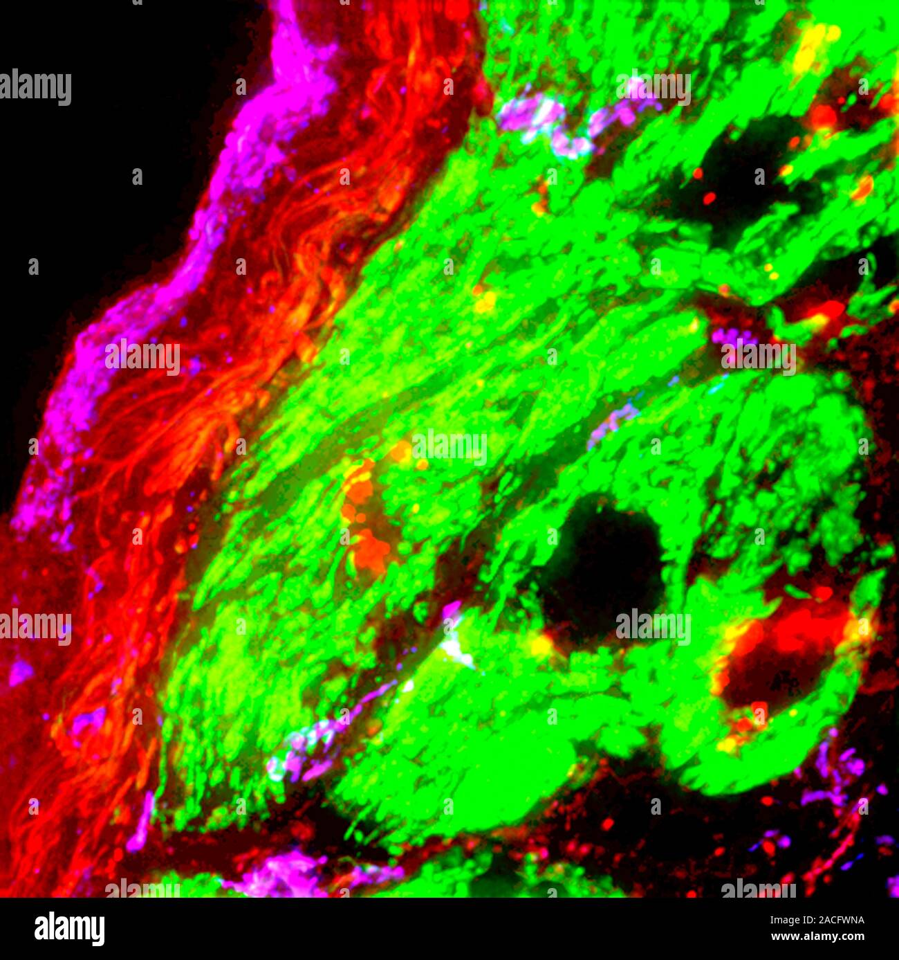 Heart failure. Fluorescent deconvolution micrograph of cardiac ...