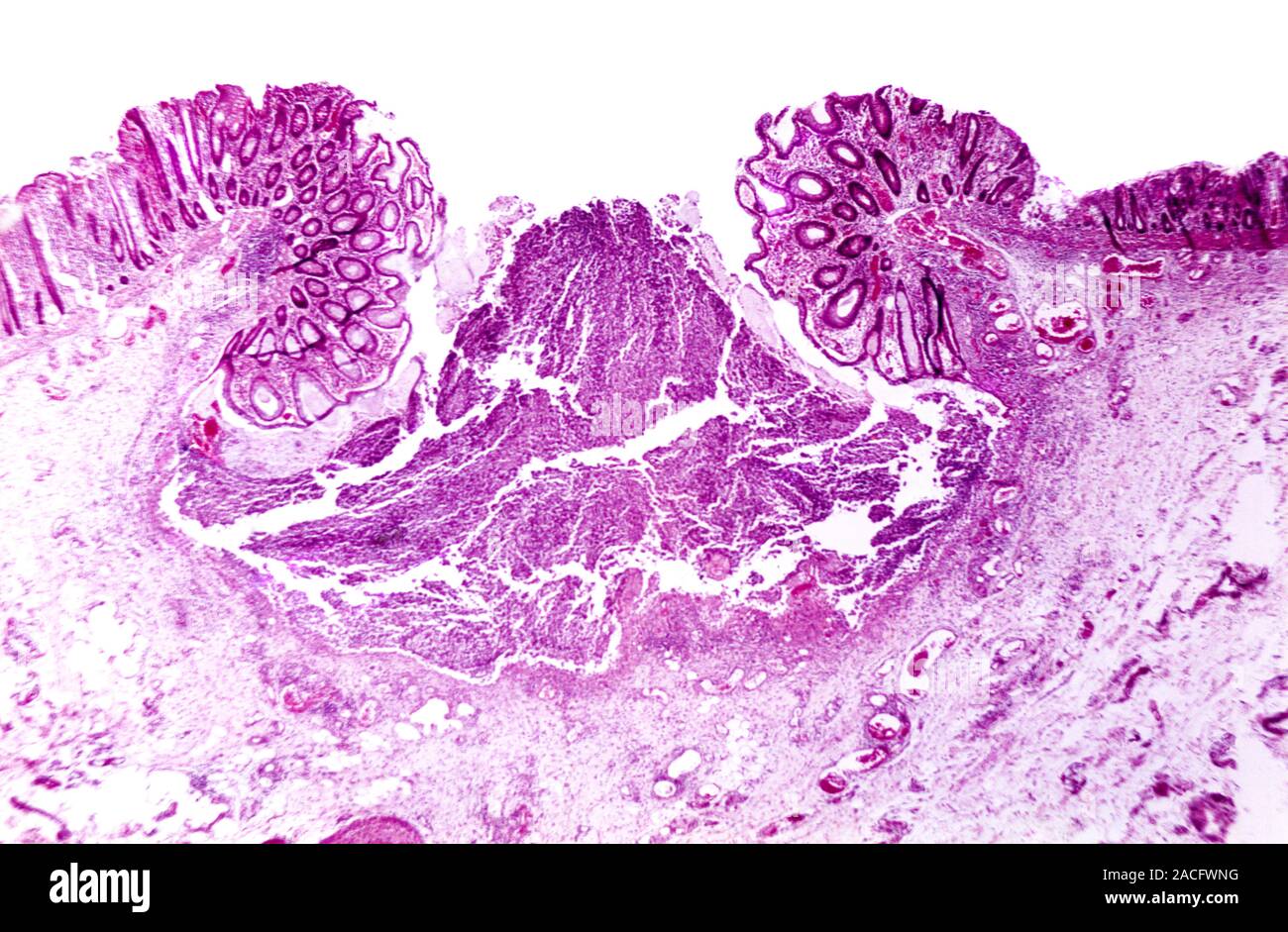 Amoebic colitis. Light micrograph of a section through a colon (part of ...
