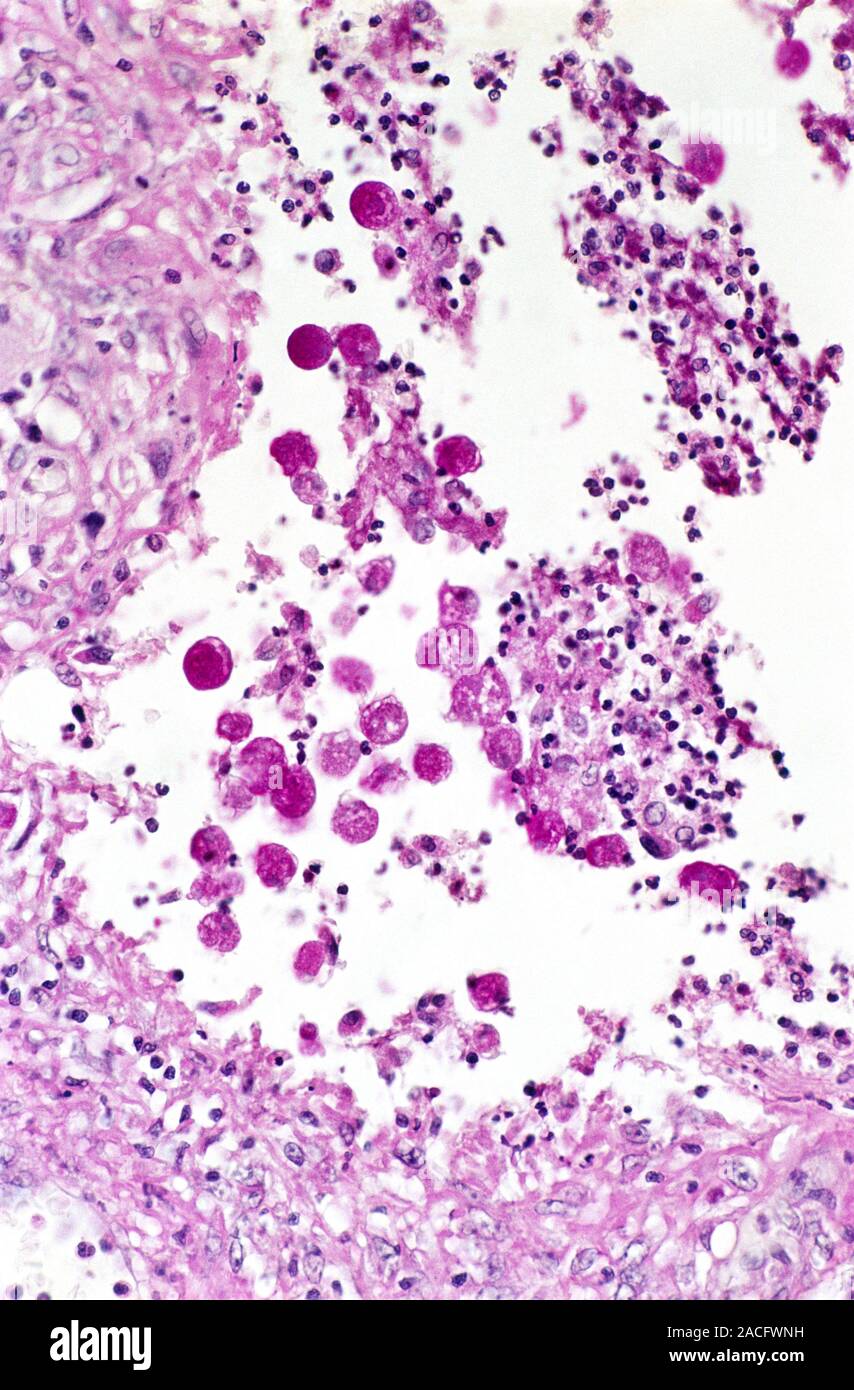 Amoebic colitis. Light micrograph of a section through a colon (part of ...