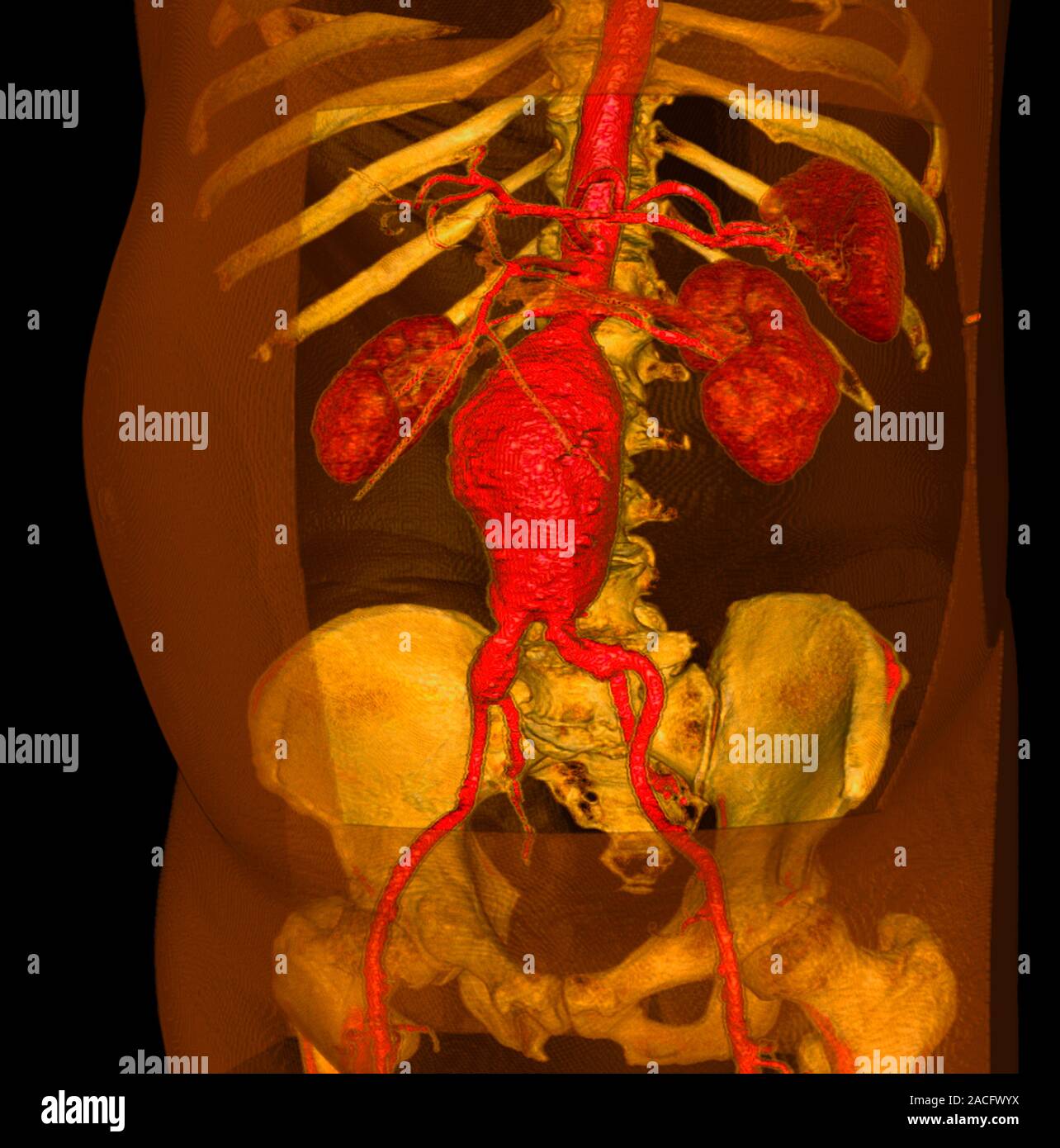 3-D Computed Tomography (CT) scan of the abdomen of a patient showing ...
