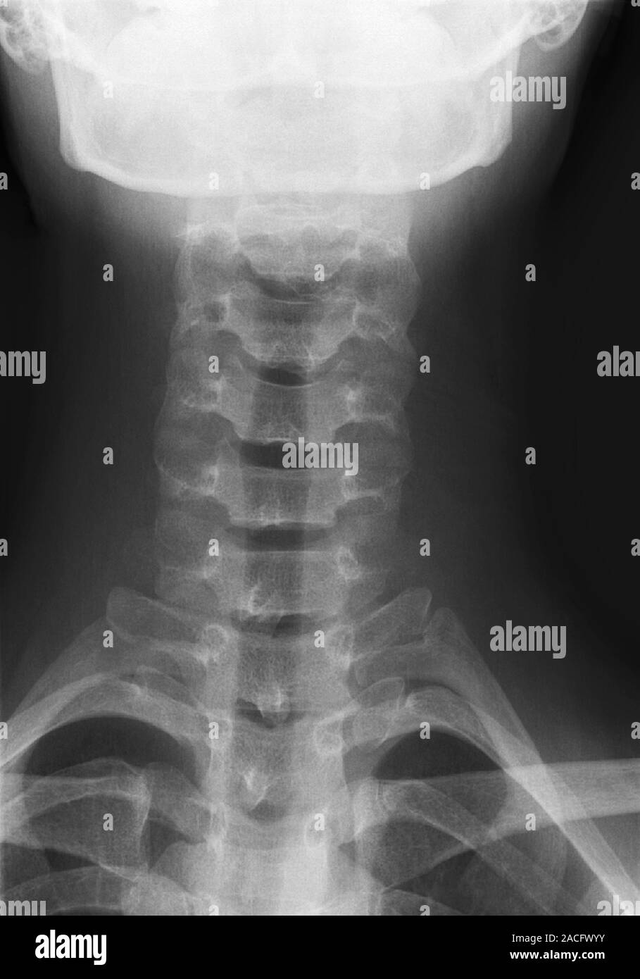 X-ray (front view) of the neck of an adult patient, showing healthy ...