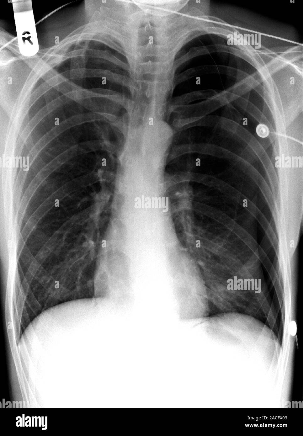 Pneumothorax (image 1 of 2). X-ray of the chest of a patient, showing ...
