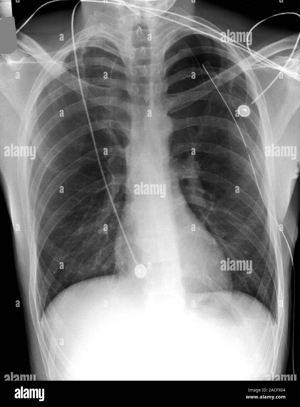 Pneumothorax treatment (image 2 of 2). X-ray of the chest of a patient ...