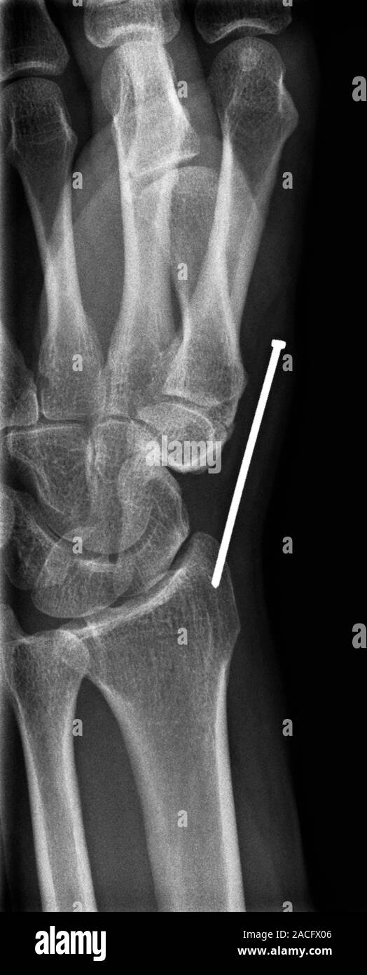 X-ray (top view) of the wrist bones of the hand, showing a long metal ...