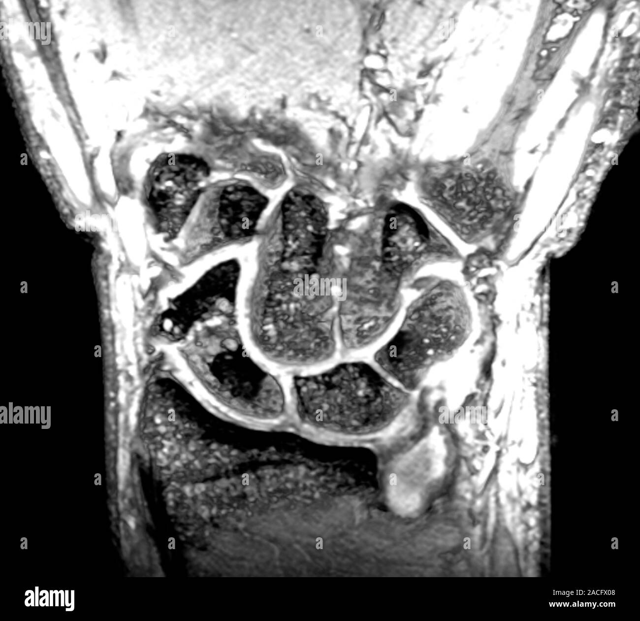 Magnetic resonance imaging (MRI) scan (thick slab) of the bones of the ...