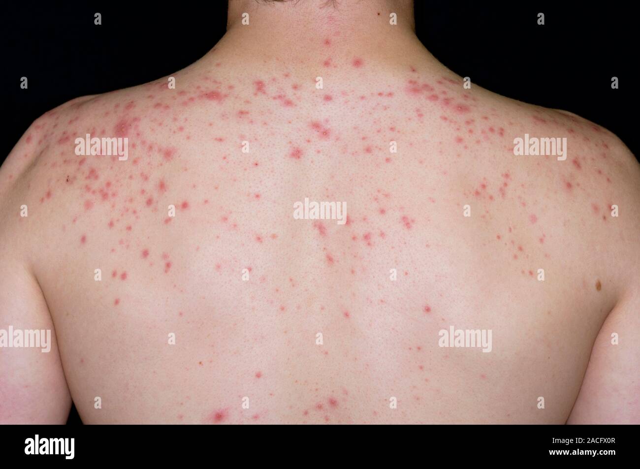 Acne vulgaris on the back of an teenage boy. Acne is a skin condition ...