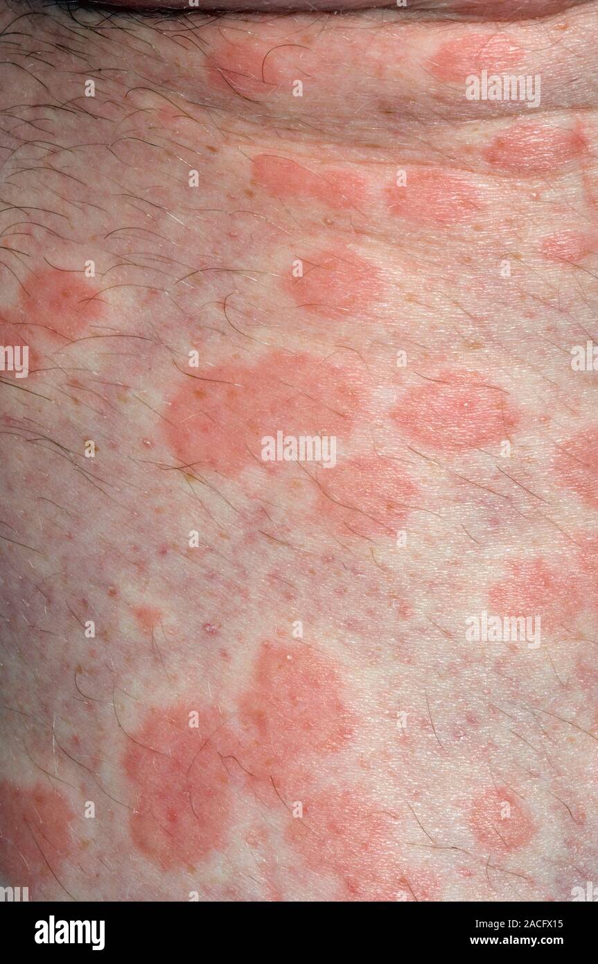 Urticaria rash on the skin of a male patient, of unknown cause ...