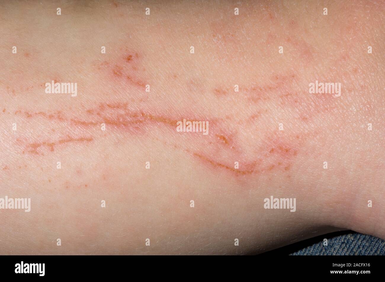Atopic eczema with scratch marks on the leg of a child. Atopic eczema ...