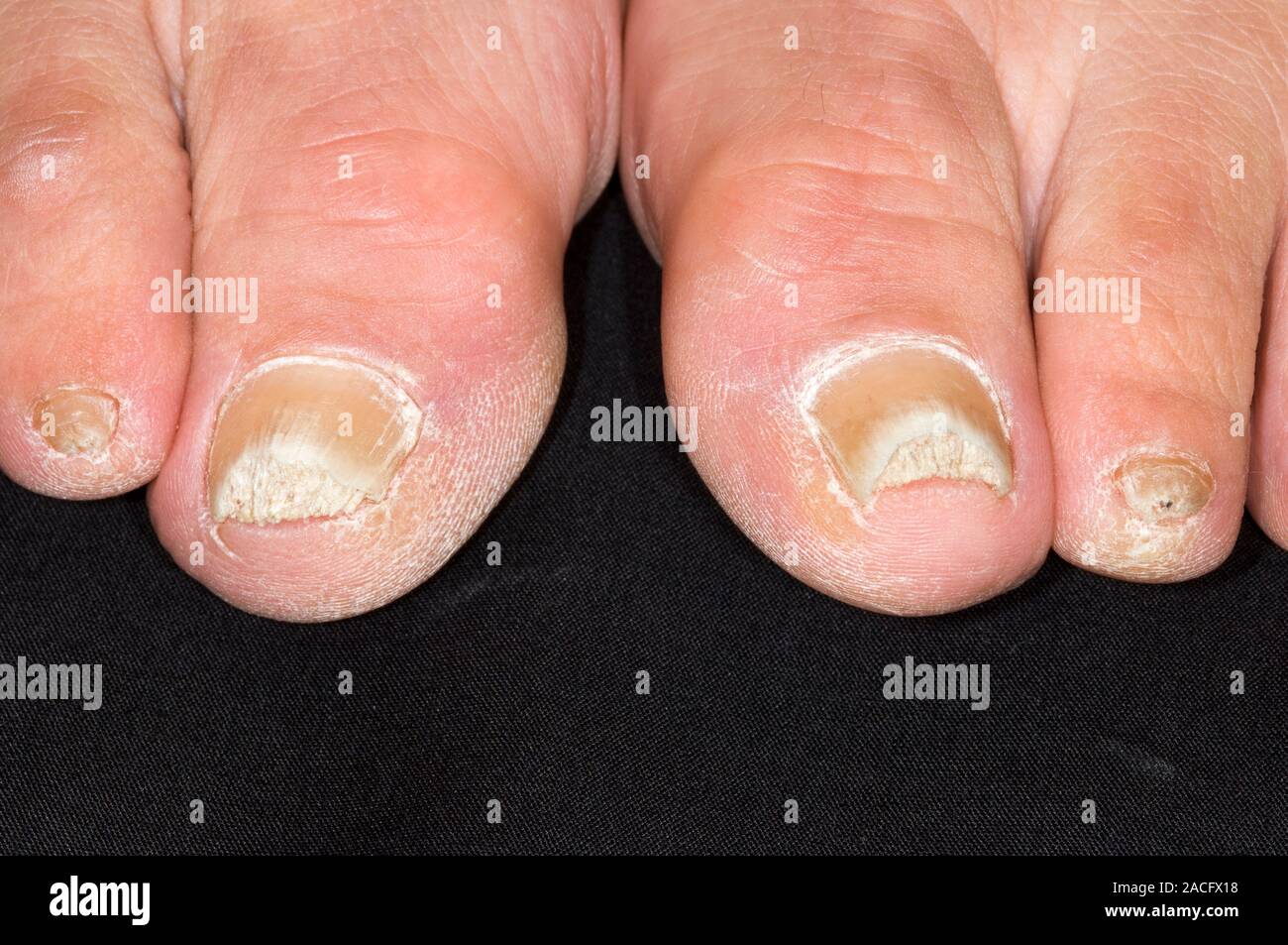 Fungal nail infection on the foot of an adult patient. Toenails with ...