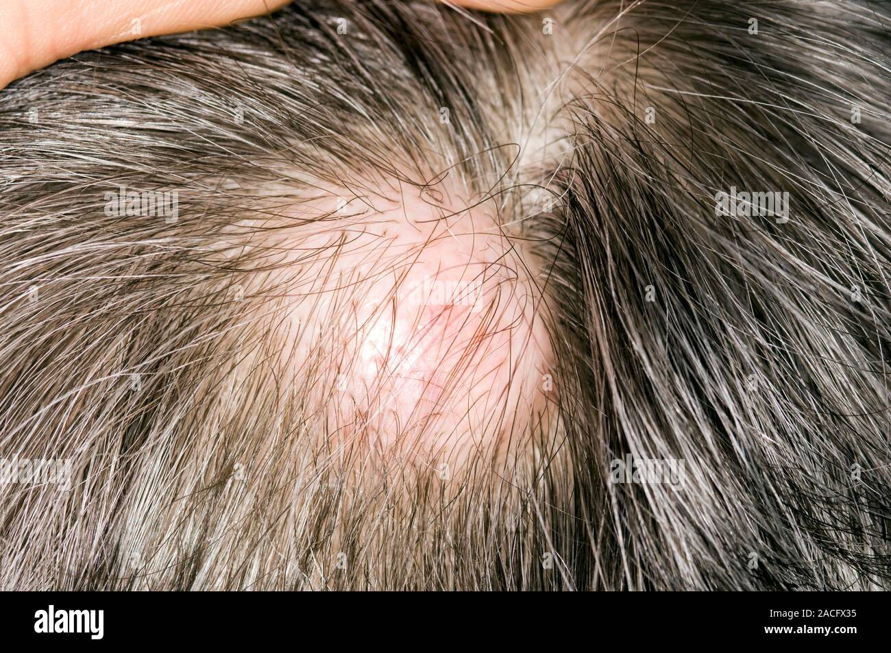 Sebaceous cyst on the scalp of an adult patient. A sebaceous cyst is a ...