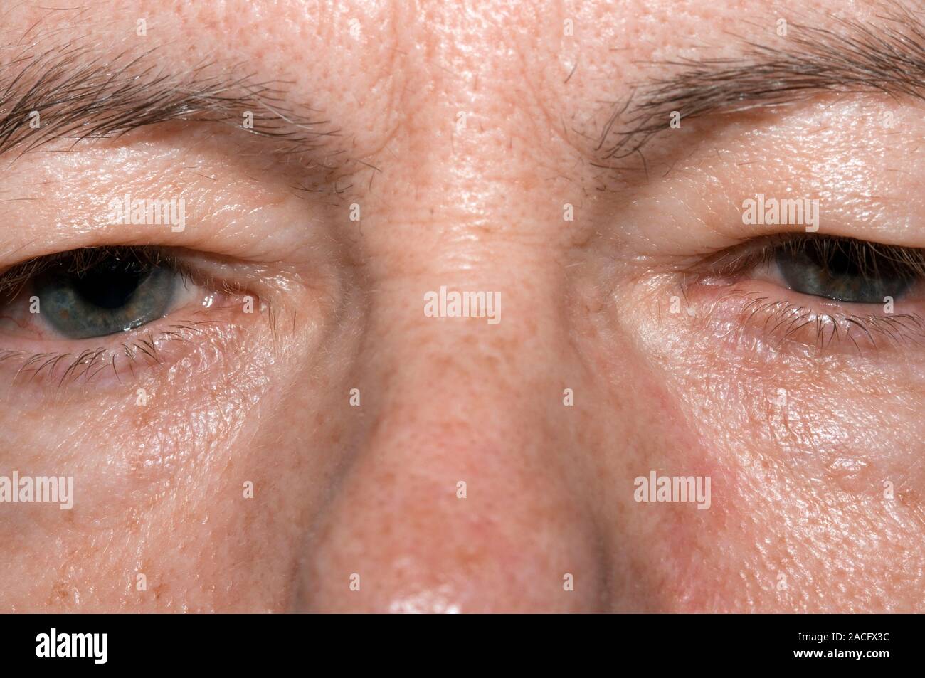 Close-up of the face of a man with Horner's syndrome, showing drooping ...