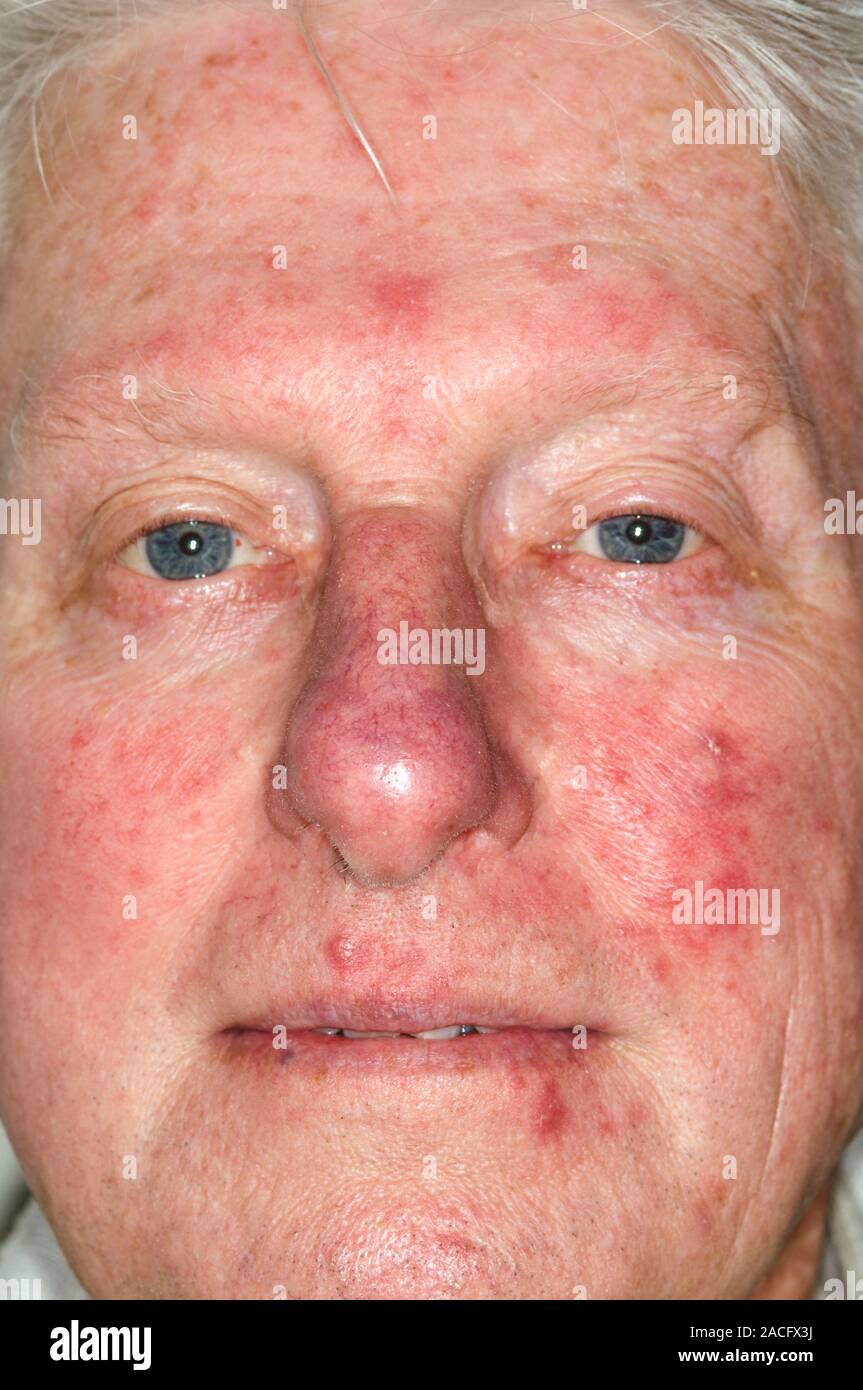 Acne rosacea rash on the face of an elderly male patient, affecting his ...