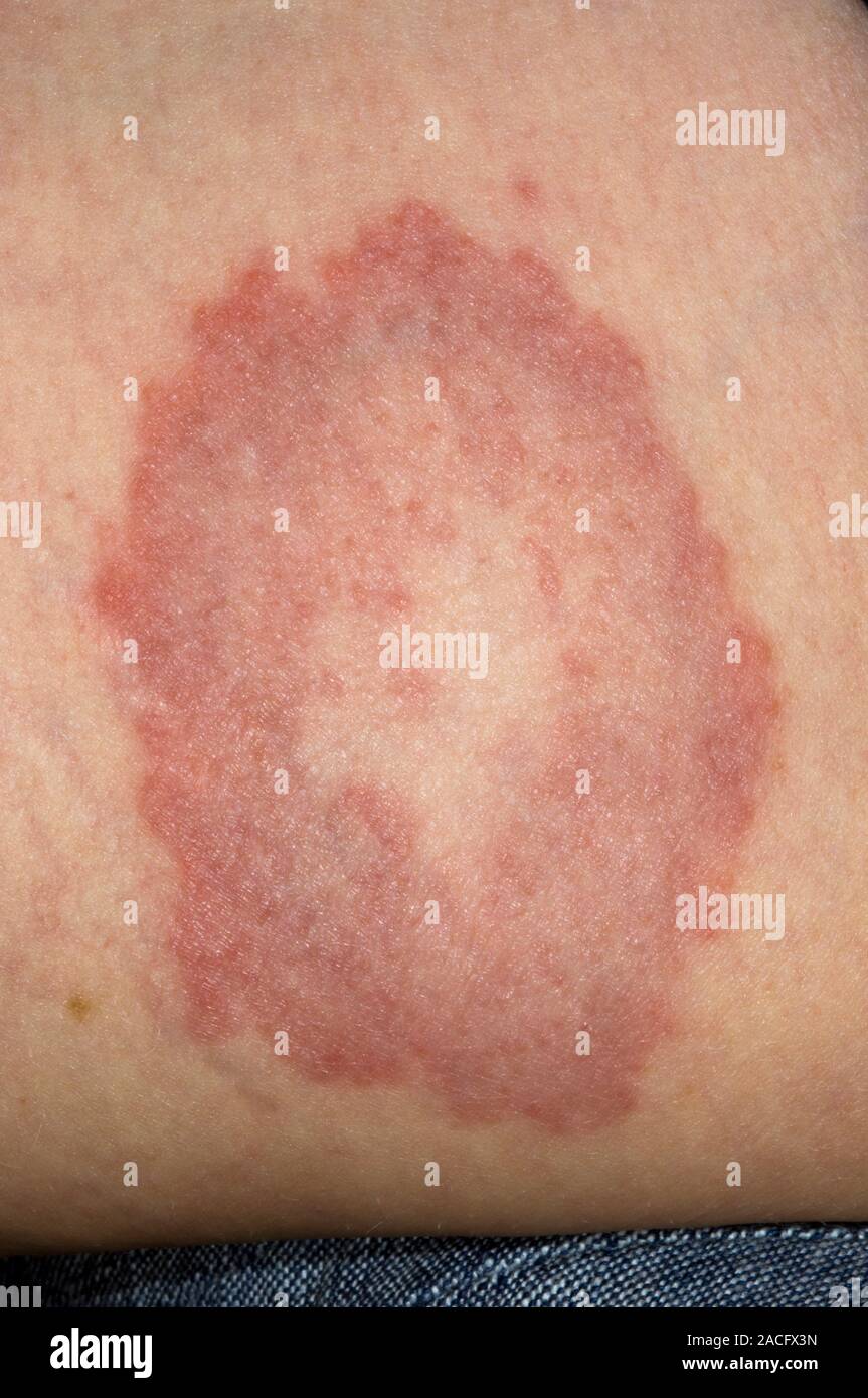 Granuloma annulare lesion on the skin of a 72 year old female patient ...