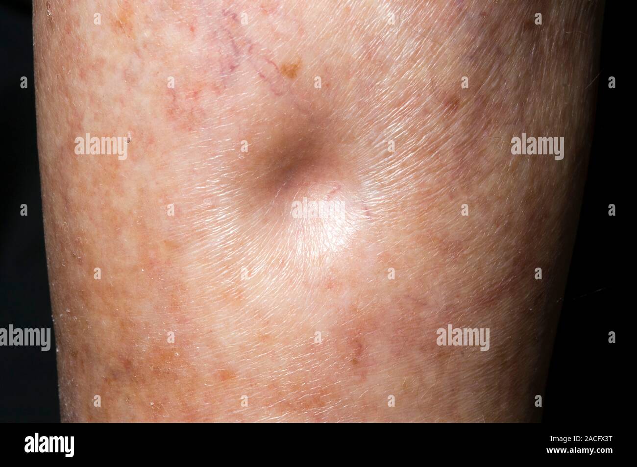 Pitting oedema in the skin of the swollen leg of an adult female ...