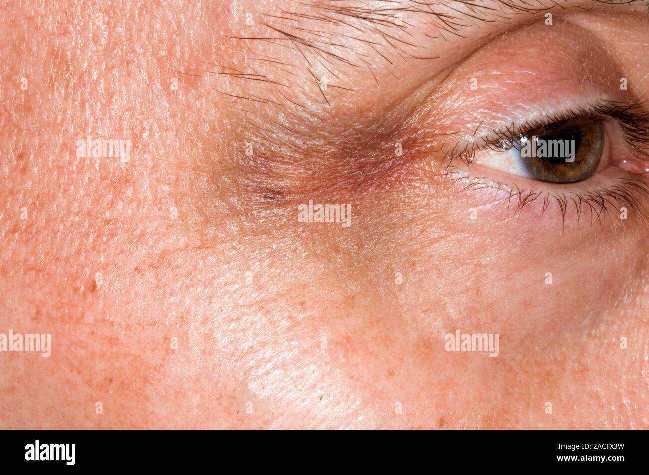 Bruise at the corner of the eye of an adult patient. Bruising ...