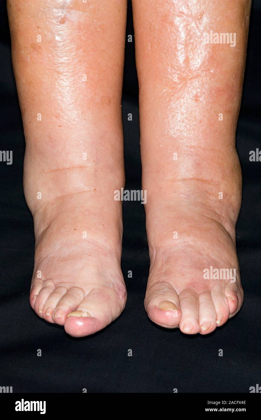 Oedema (swelling) of the ankles of the legs of an adult female patient ...